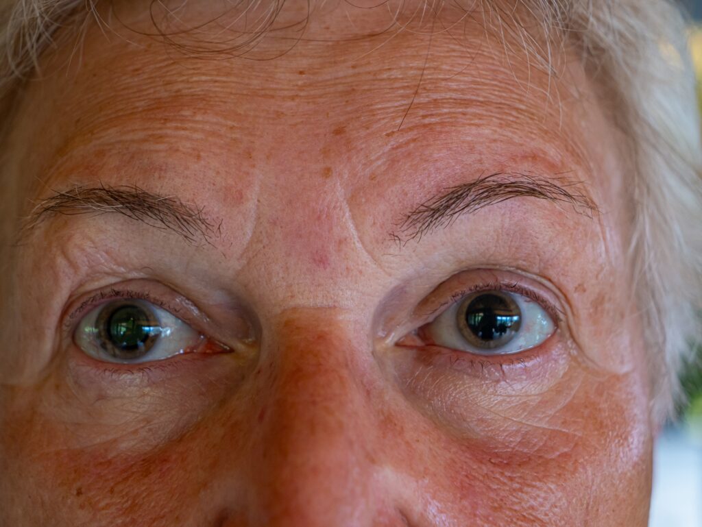 Disease area: Eye Disease - IPM Alliance